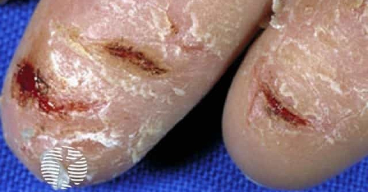 Hand dermatitis image