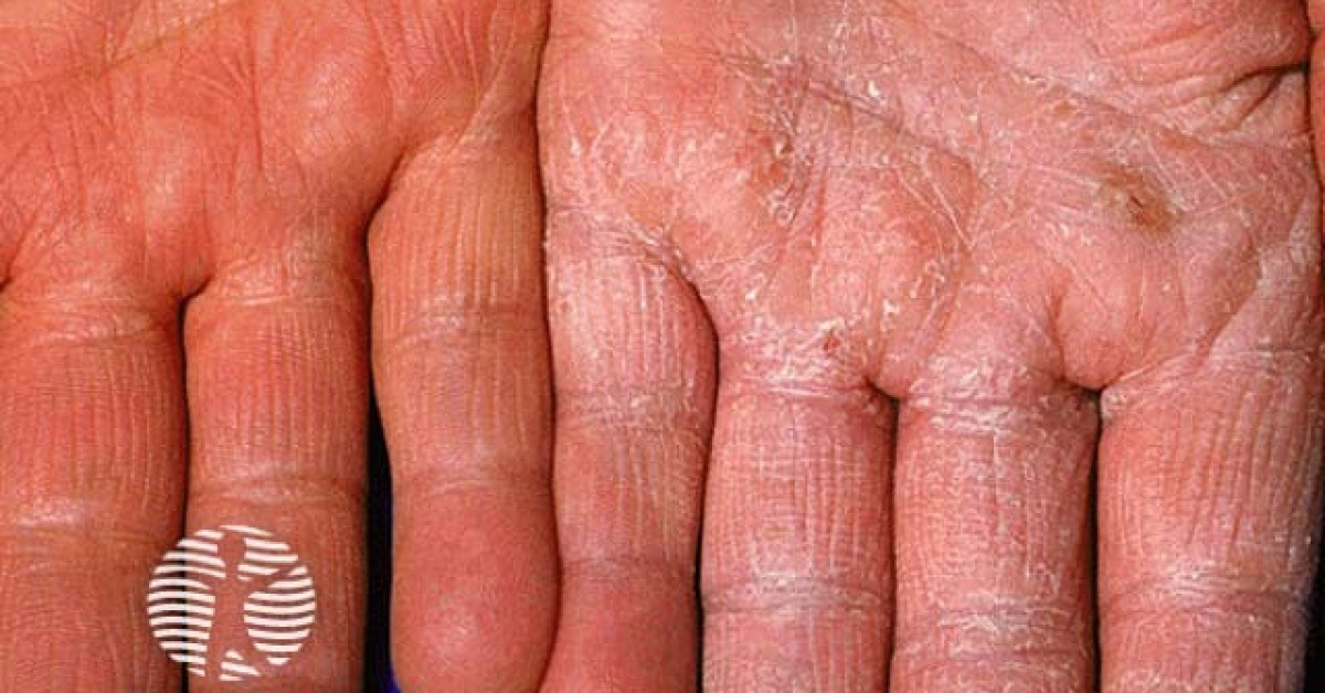 Hand dermatitis image