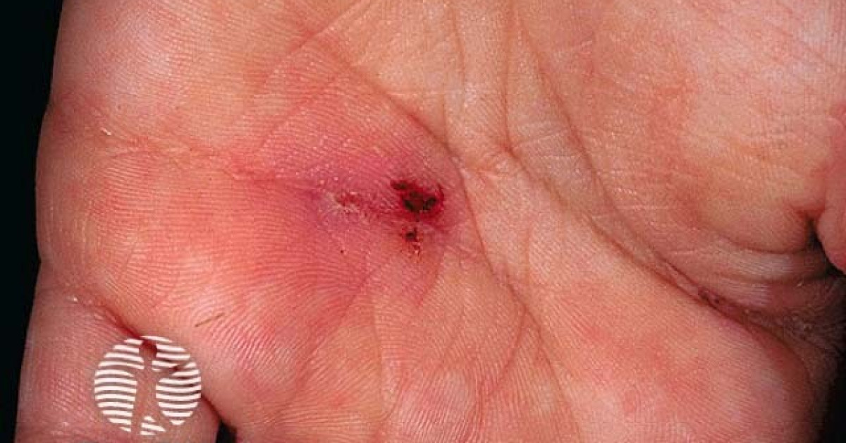 DermNet® - Hand dermatitis image