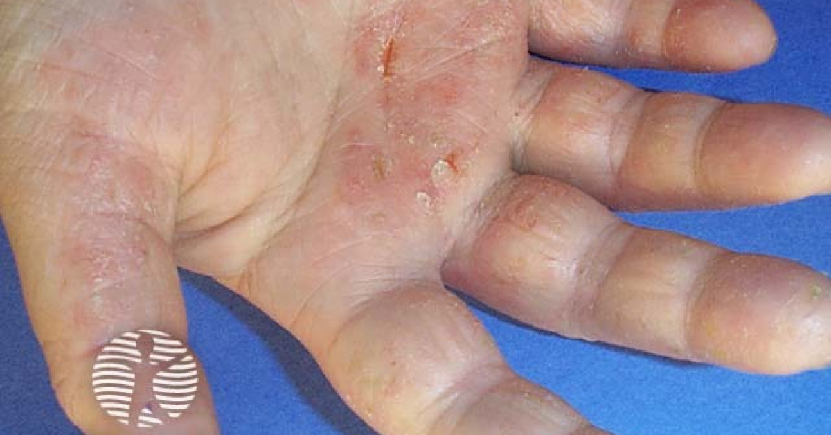 Hand dermatitis image