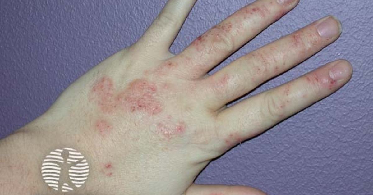 Hand dermatitis image