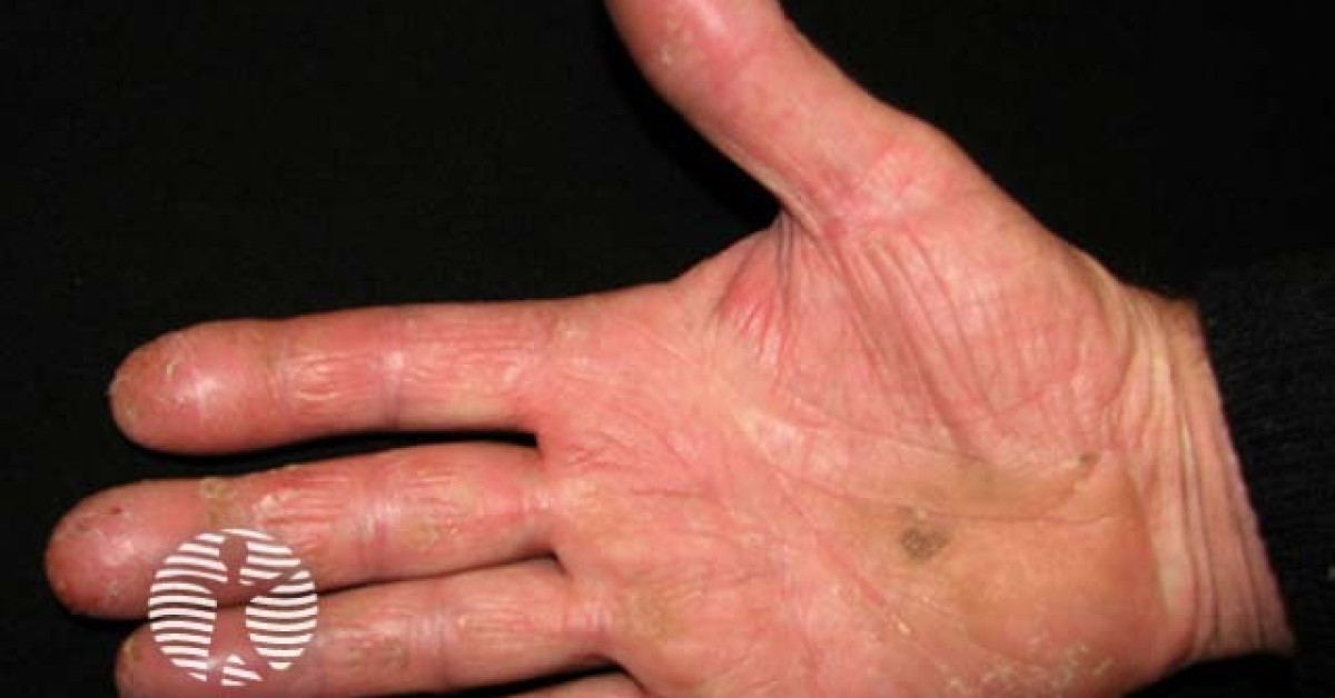 DermNet® - 2850 image