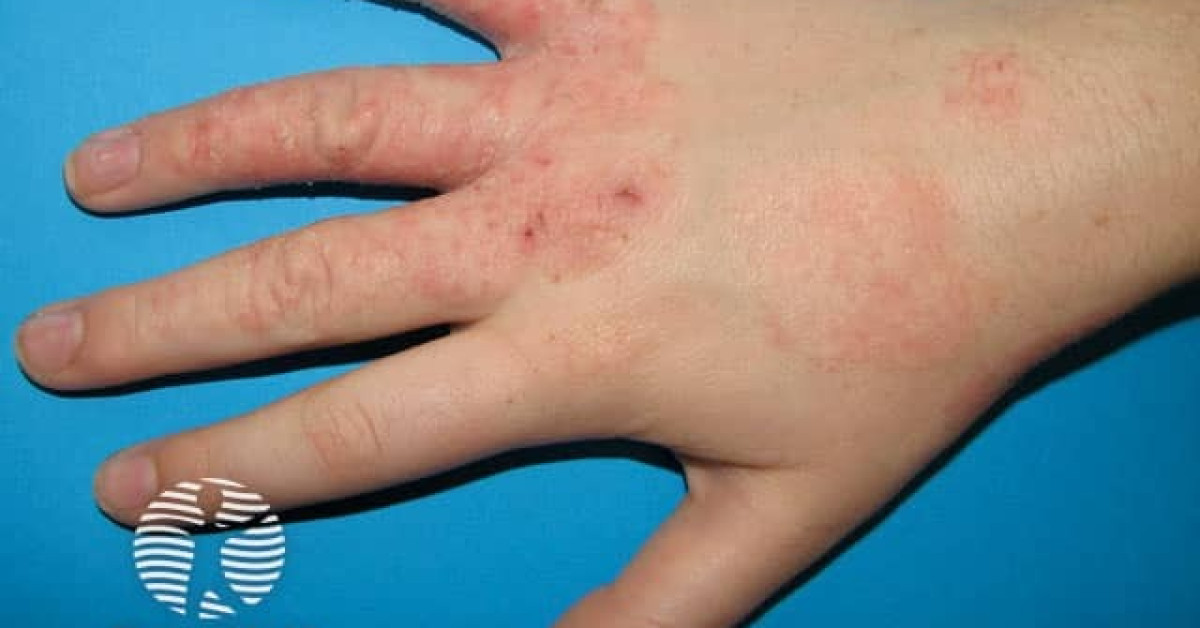 Hand dermatitis image