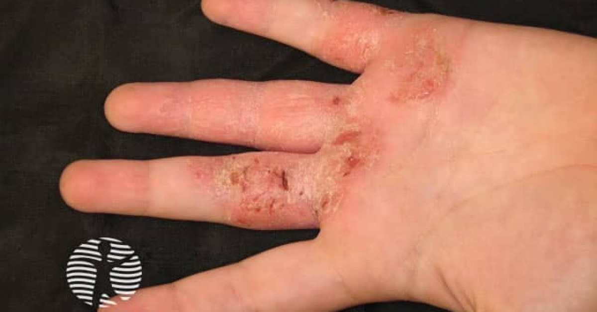 Hand dermatitis image