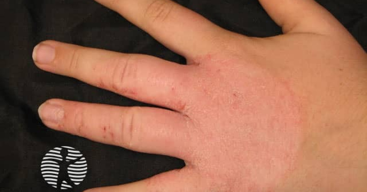 hand dermatitis image