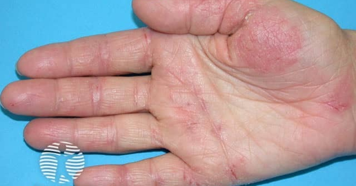hand dermatitis image