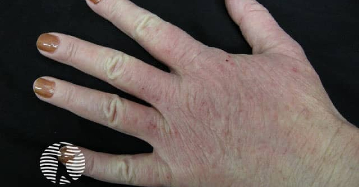 Hand dermatitis image