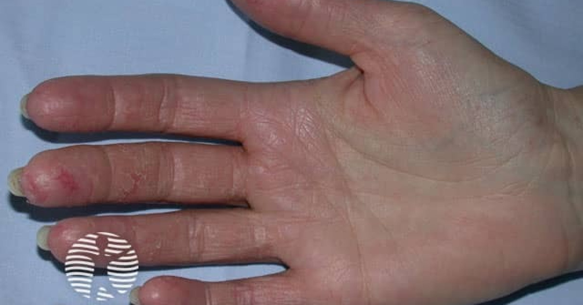Hand dermatitis image