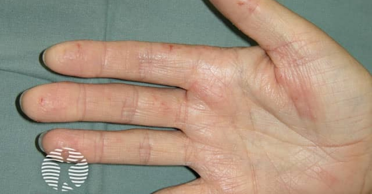Hand dermatitis image