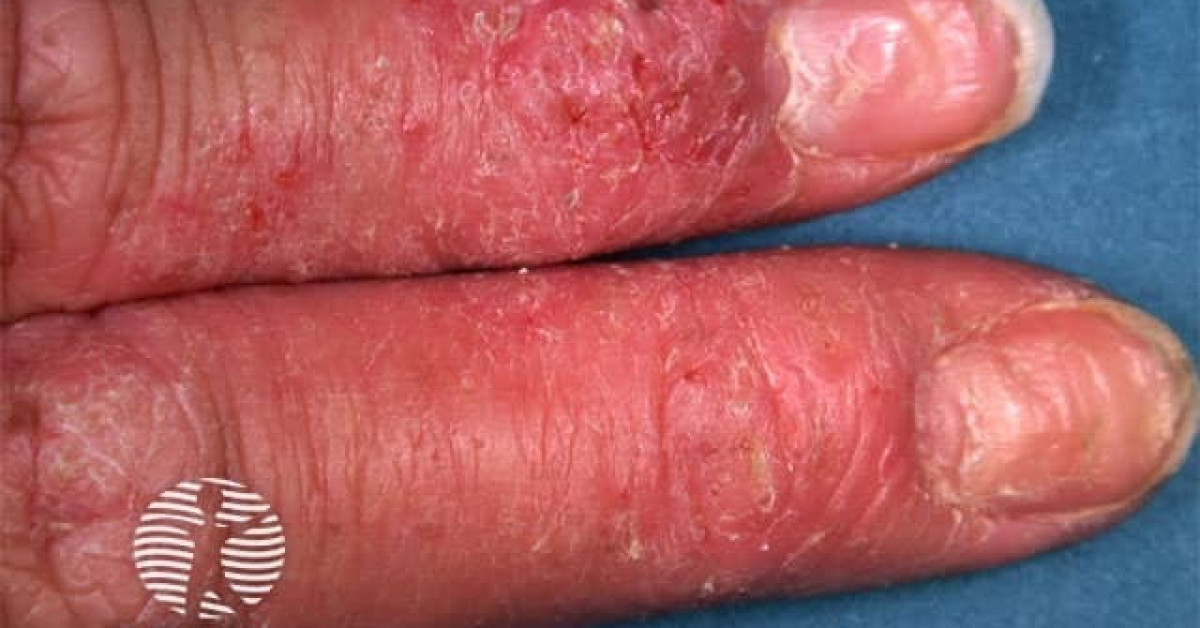 Hand dermatitis image