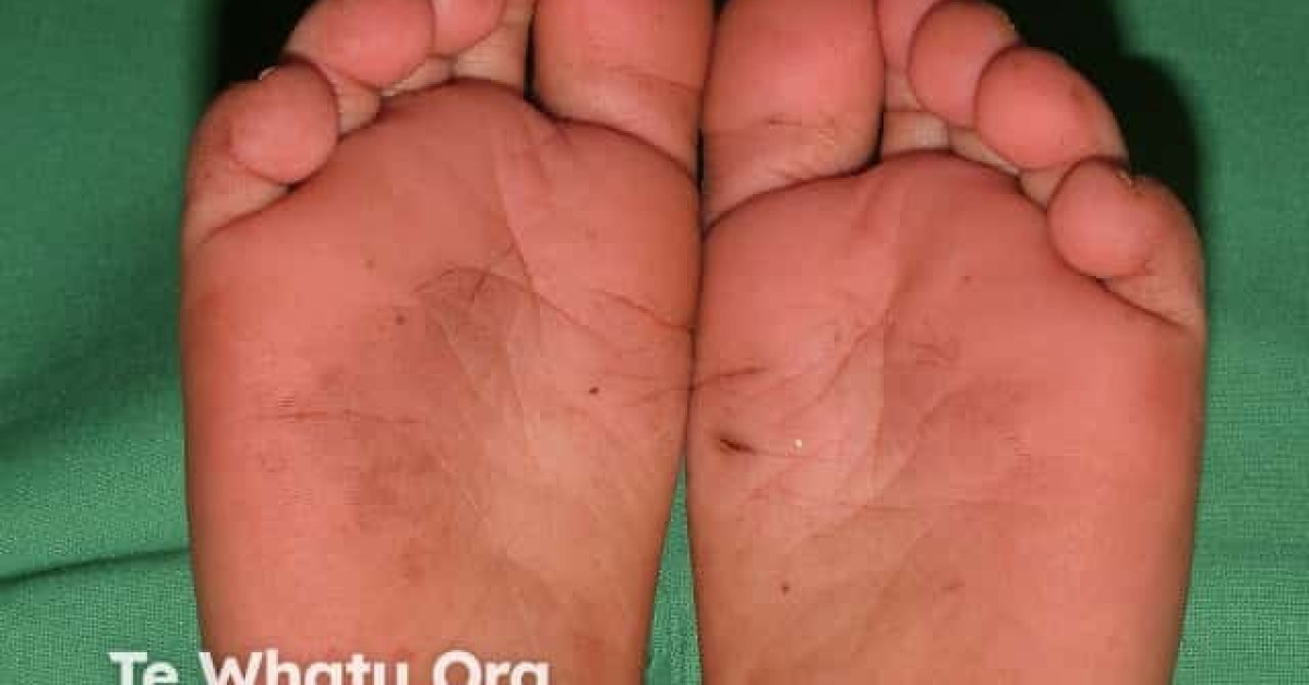 Juvenile plantar dermatosis image