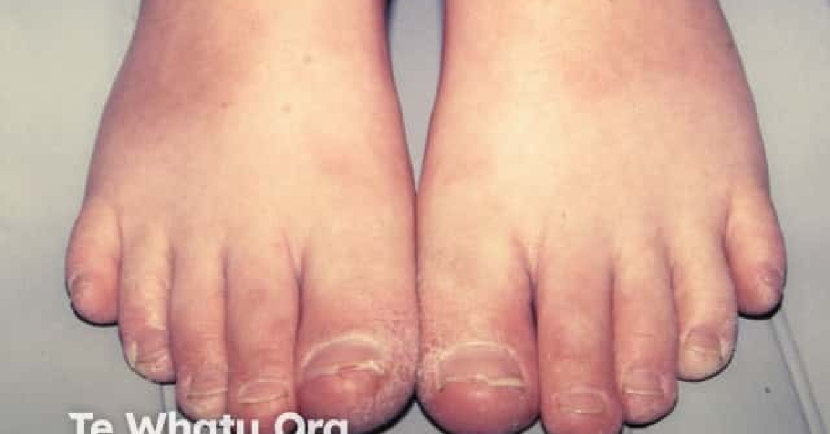 Juvenile plantar dermatosis image