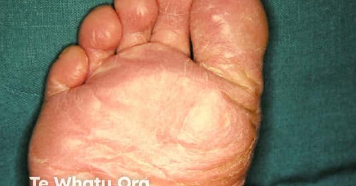 Juvenile plantar dermatosis image