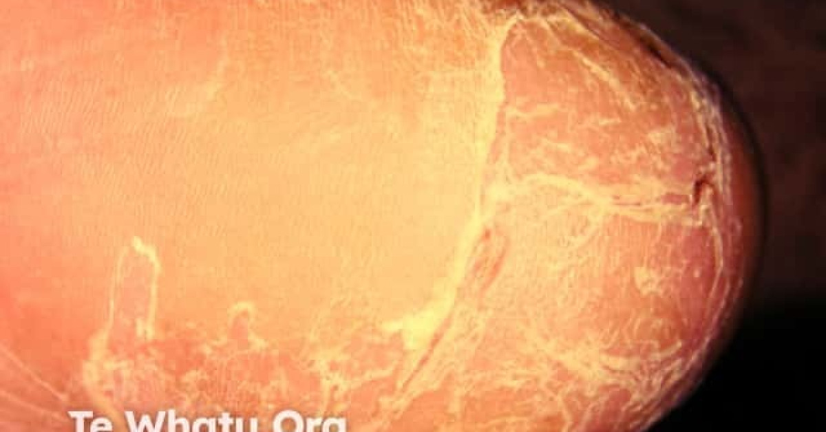 Juvenile plantar dermatosis image