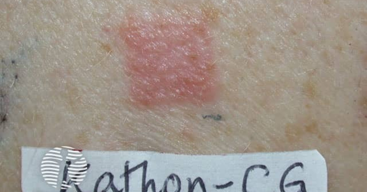 Positive patch test to isothiazolinone image