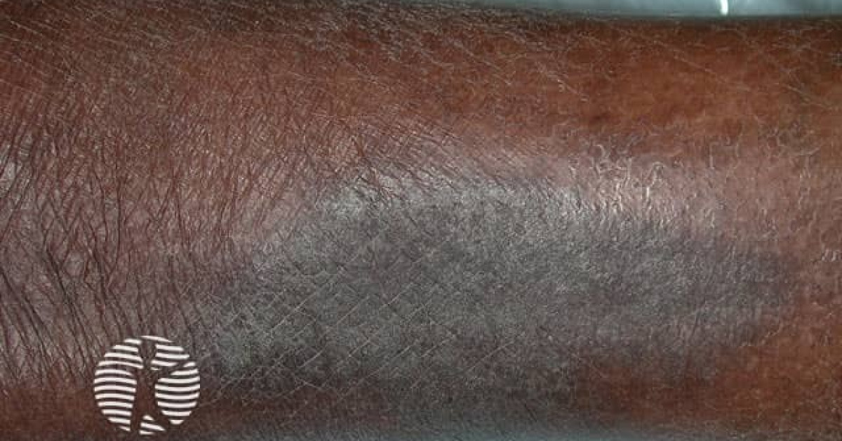 Lichen simplex image