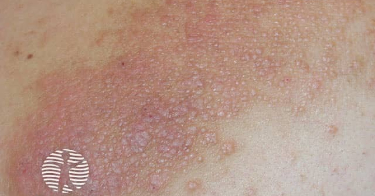 Lichen simplex image