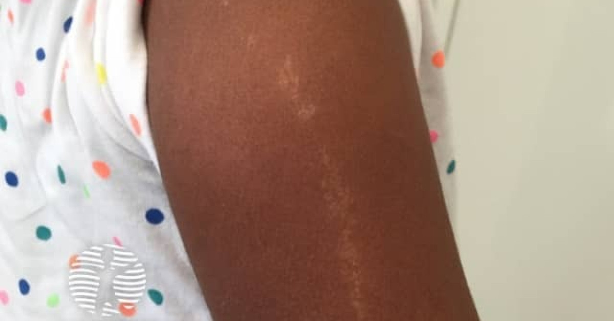 Lichen striatus image