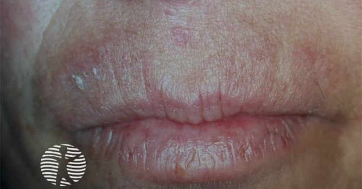 Cheilitis due to hair dye allergy image