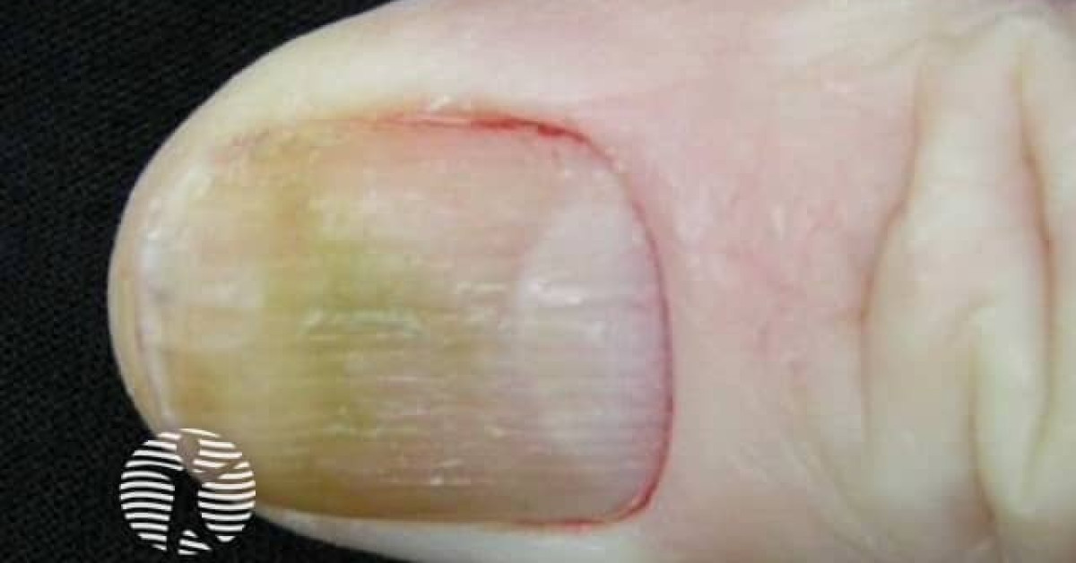 Onycholysis as reaction to artificial nails image