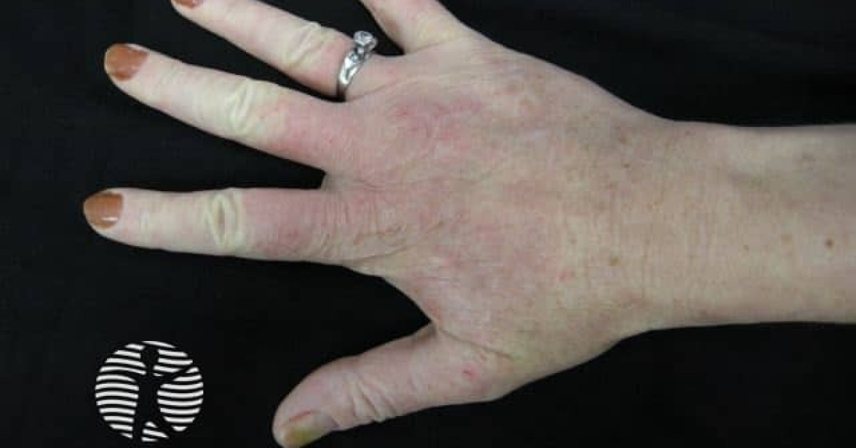 Dermatitis as reaction to artificial nails image
