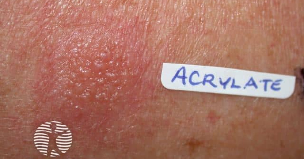 Onycholysis as reaction to artificial nails image