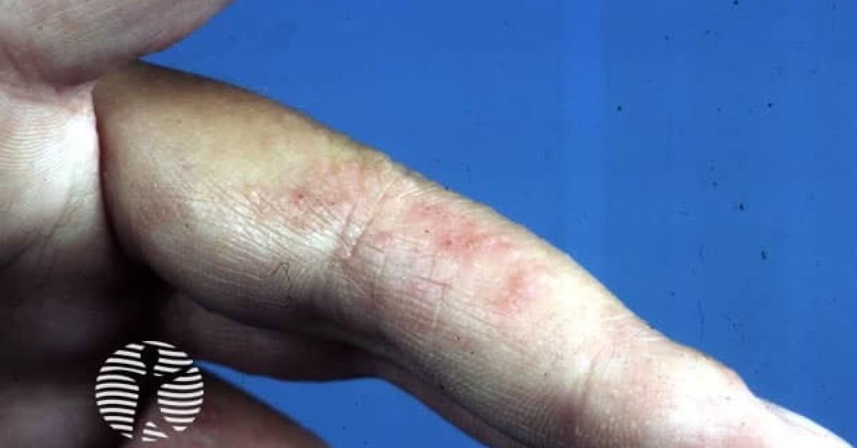 DermNet® - nickel allergy image