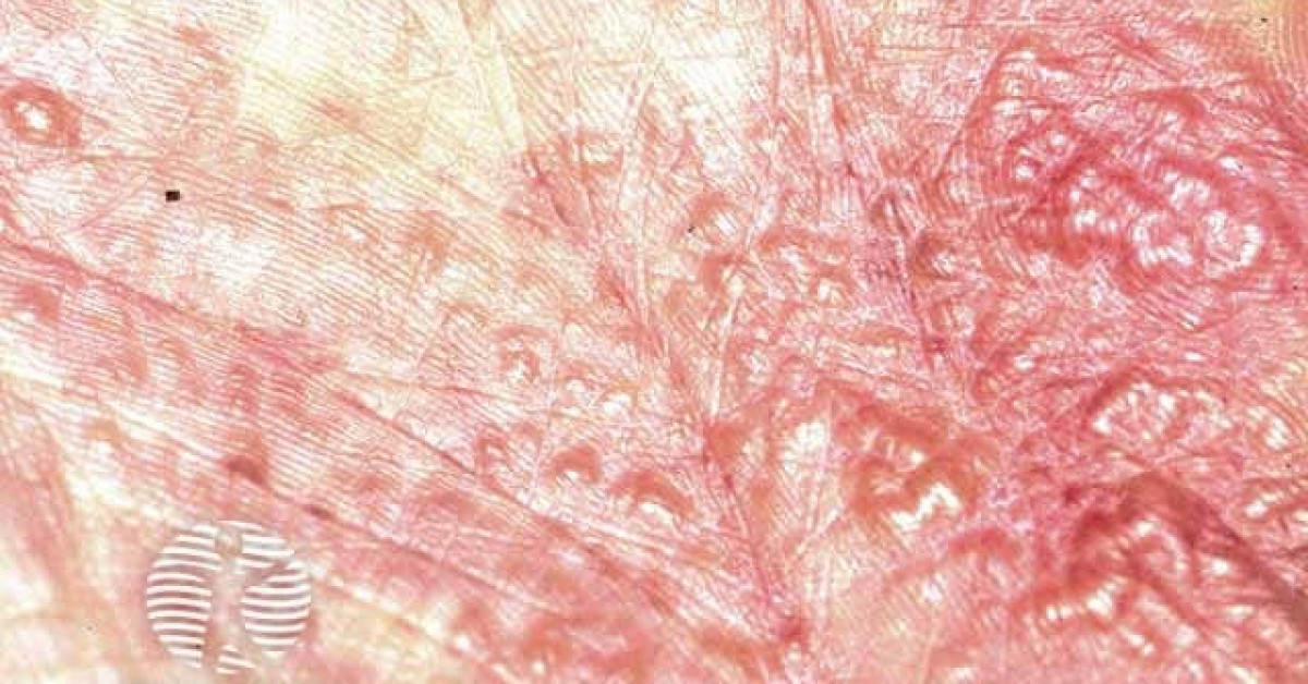 nickel allergy image