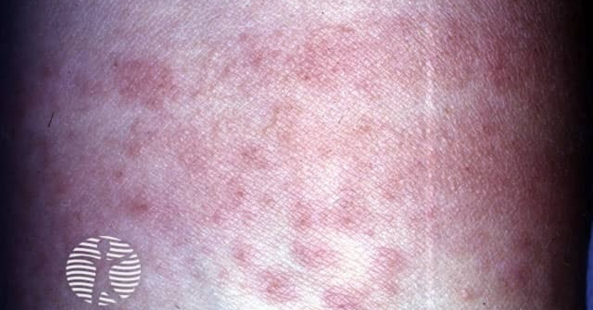 nickel allergy image