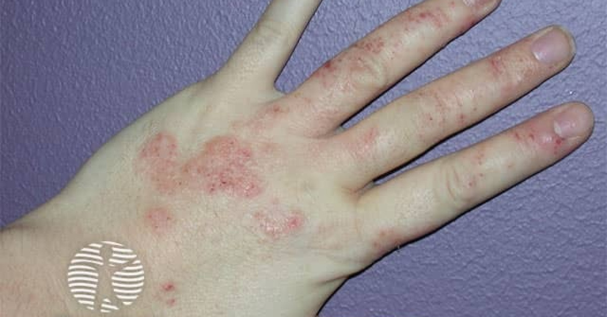 hand dermatitis image