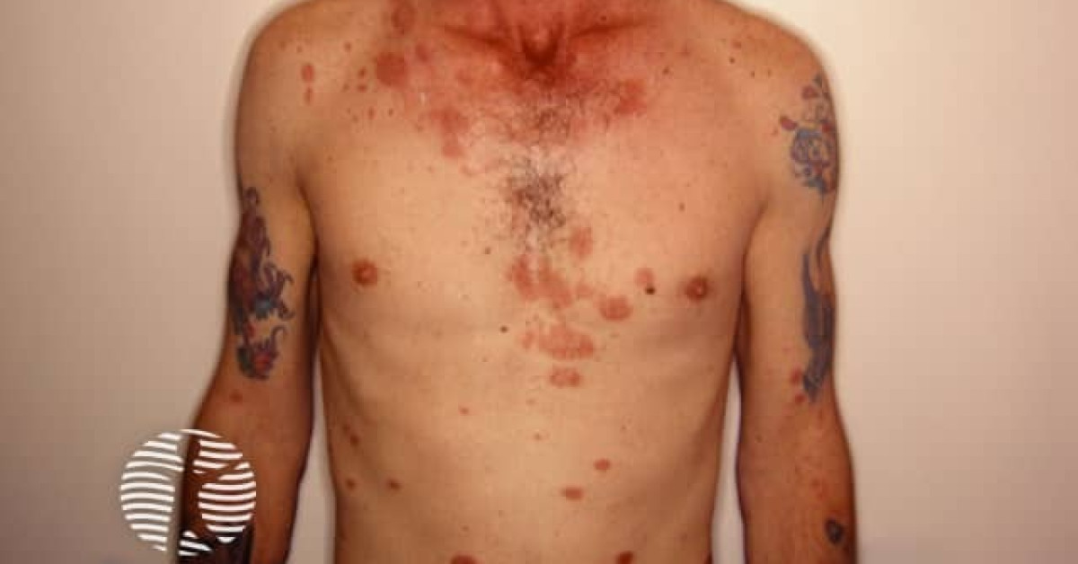Nummular dermatitis discoid eczema image