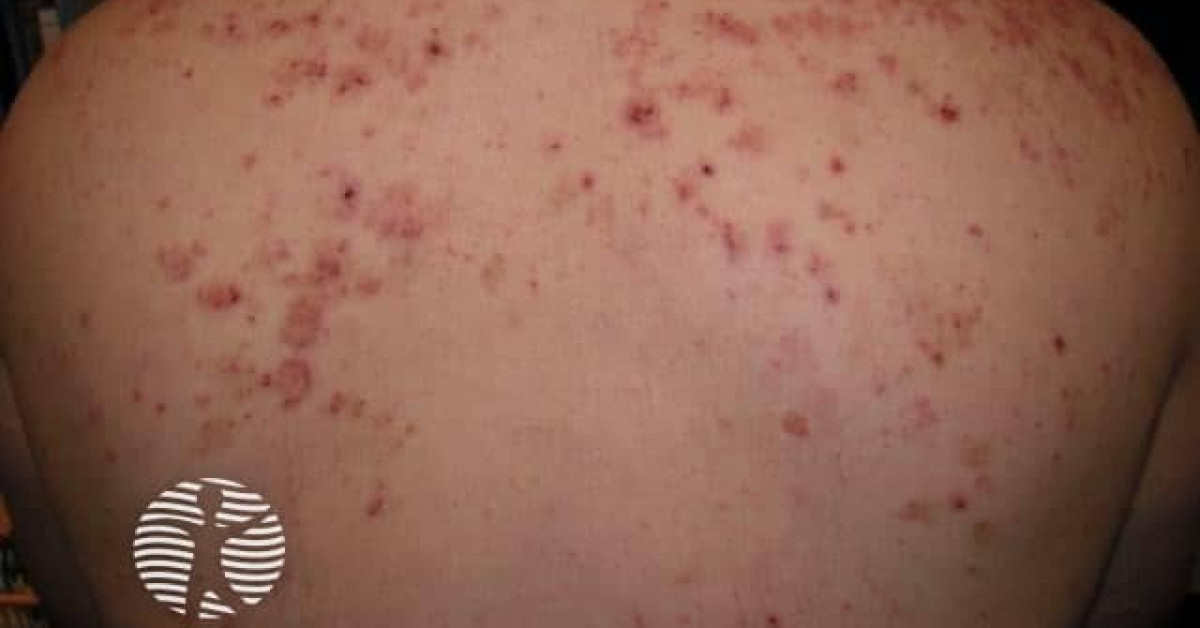 Nummular dermatitis discoid eczema image