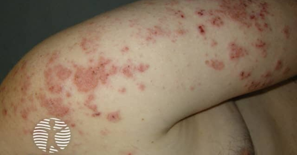 Nummular dermatitis discoid eczema image