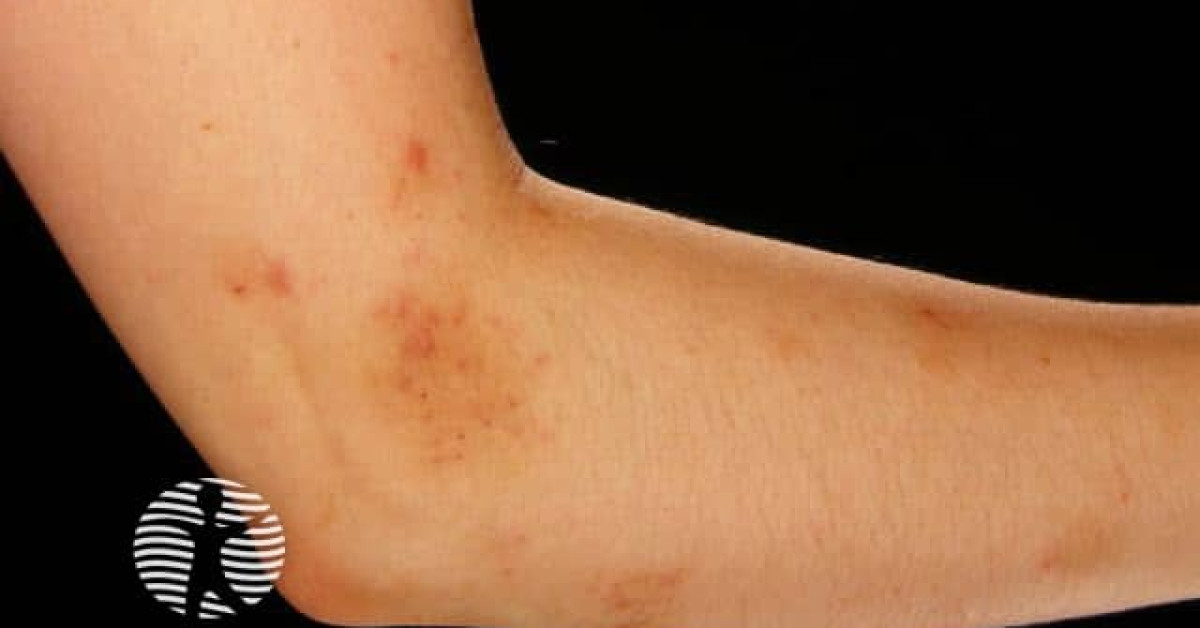 Nummular dermatitis discoid eczema image