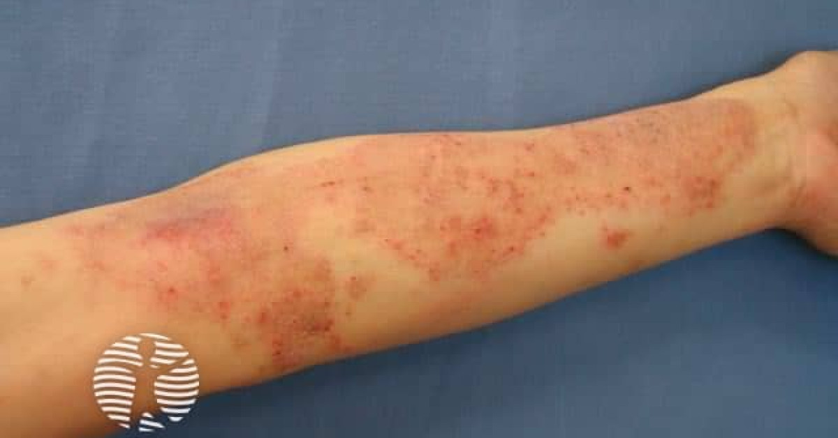 Discoid eczema image