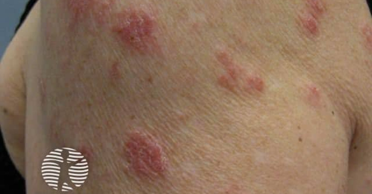 Nummular dermatitis image