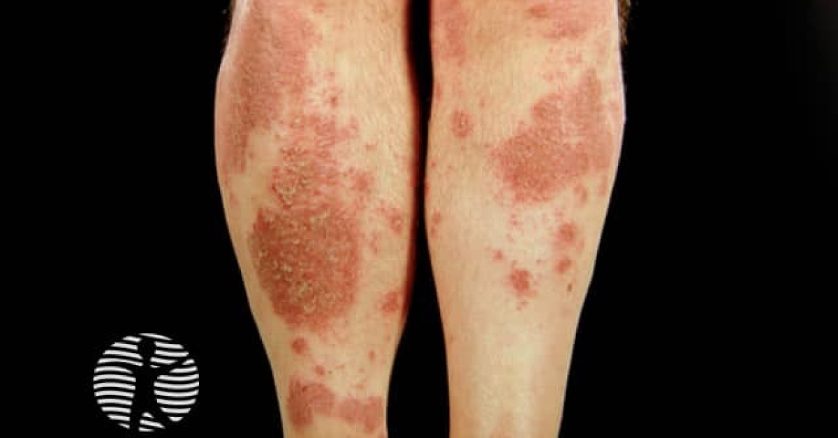 Nummular dermatitis discoid eczema image