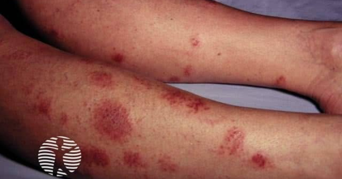 Nummular dermatitis discoid eczema image