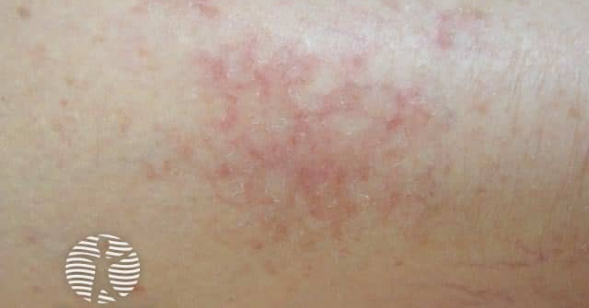 Nummular dermatitis discoid eczema image