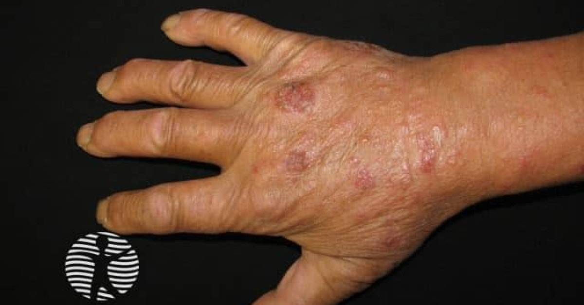 Nummular dermatitis discoid eczema image