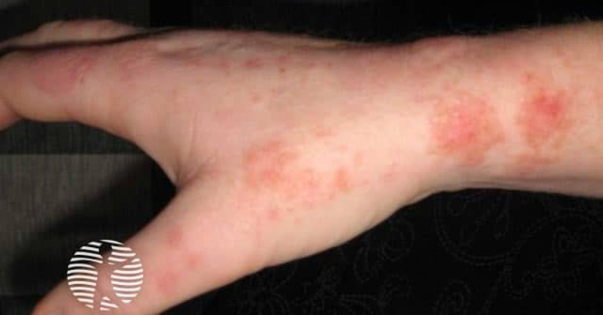 Nummular dermatitis discoid eczema image