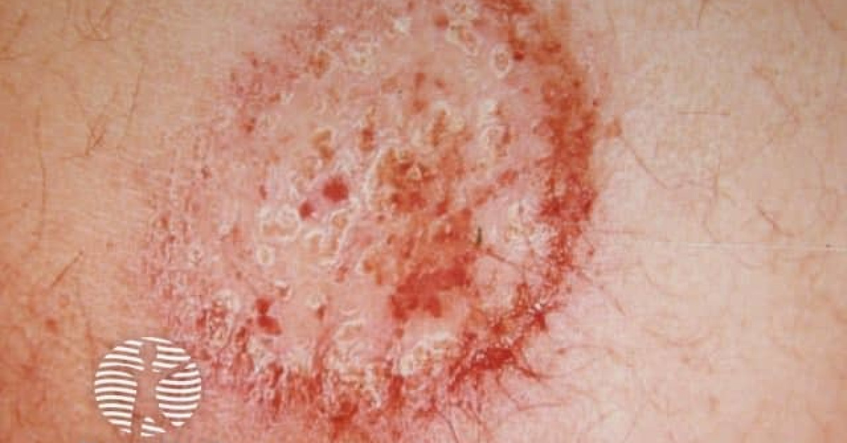 Nummular dermatitis discoid eczema image