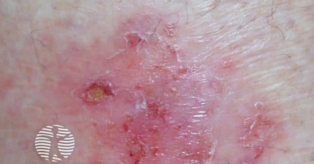 Nummular dermatitis discoid eczema image