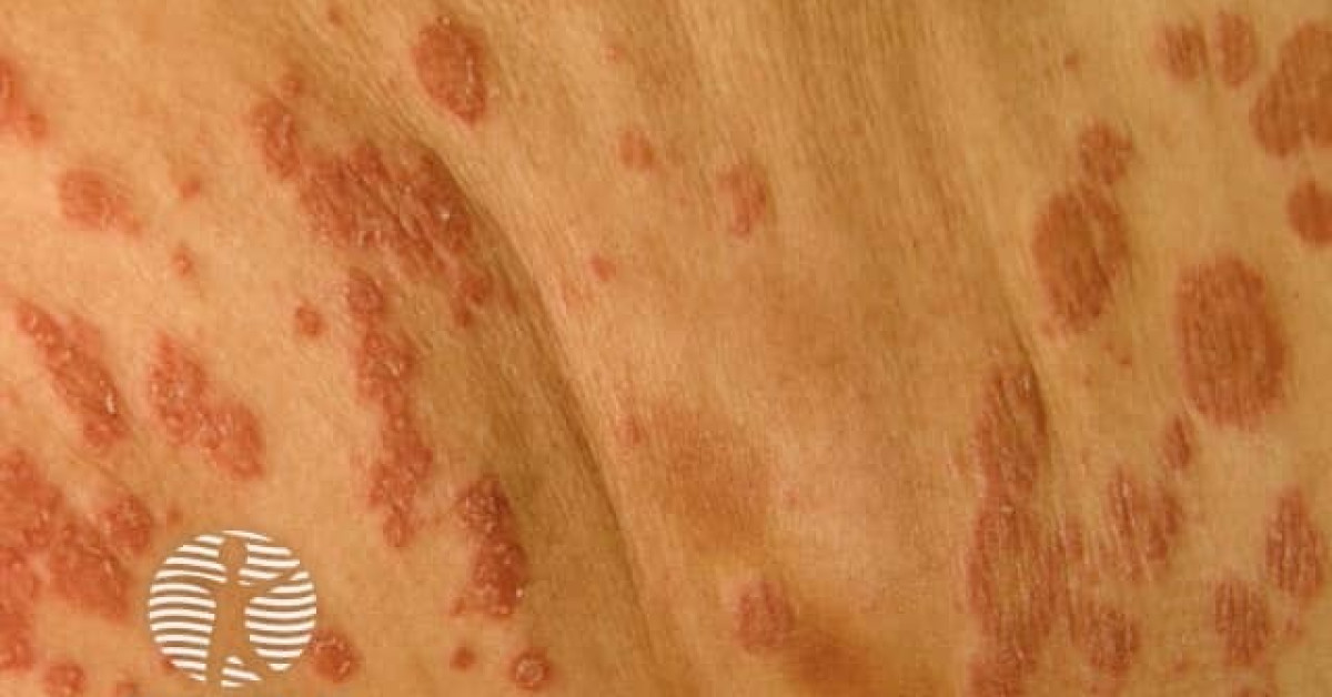 Nummular dermatitis discoid eczema image