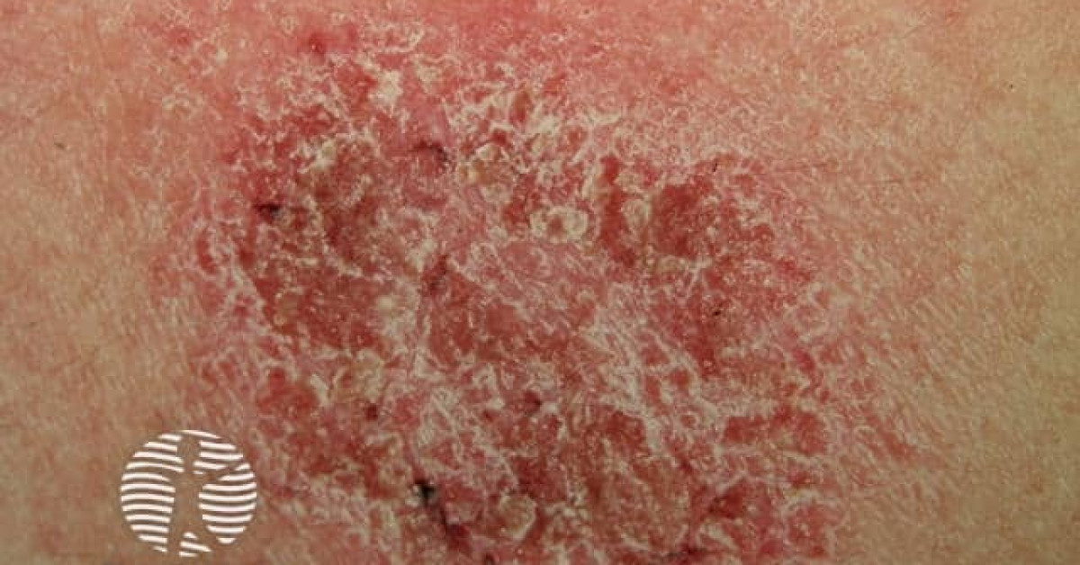 Nummular dermatitis discoid eczema image
