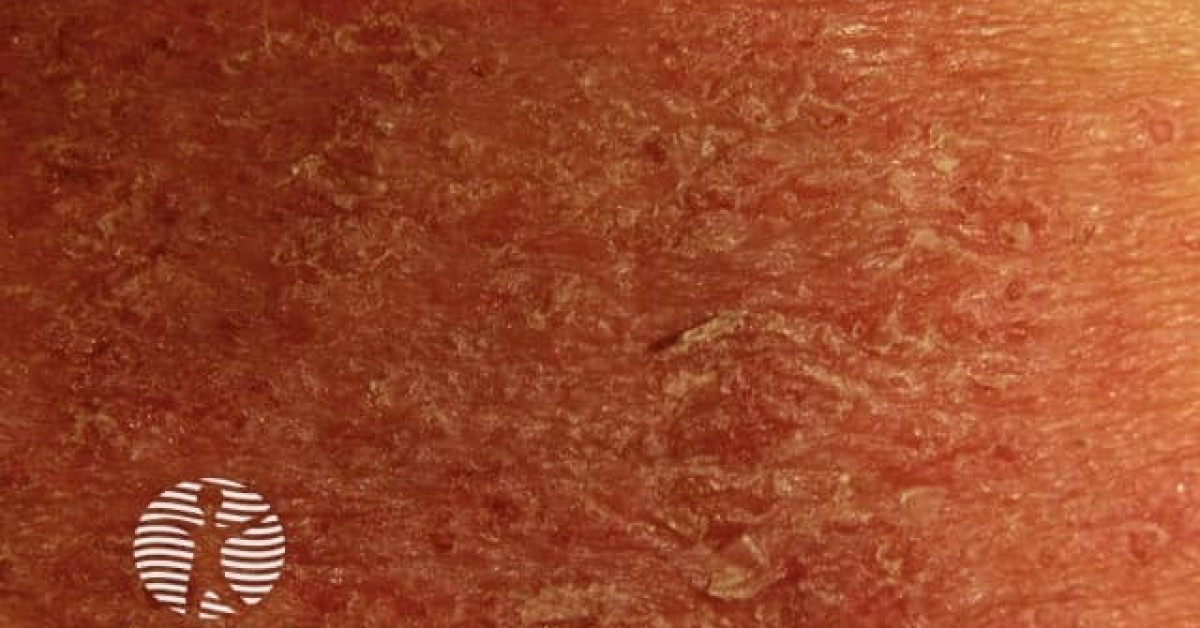 Nummular dermatitis discoid eczema image