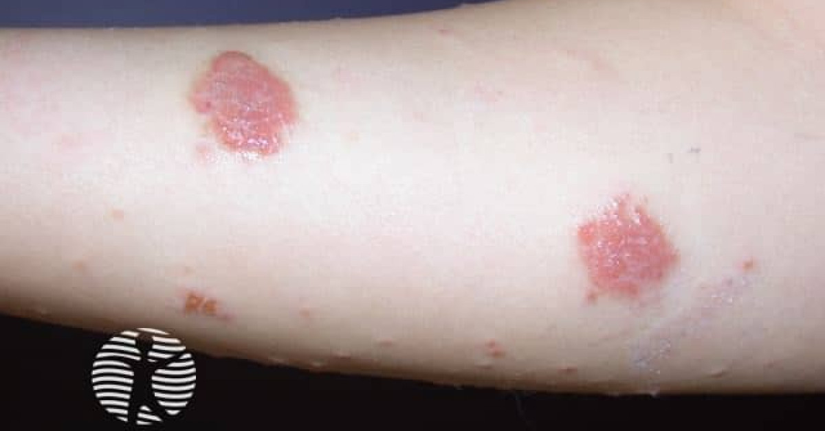 Nummular dermatitis discoid eczema image