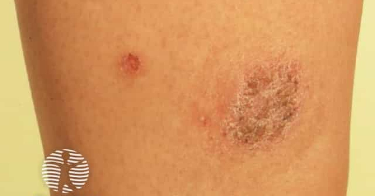 Nummular dermatitis discoid eczema image