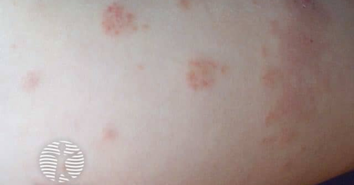 Nummular dermatitis discoid eczema image