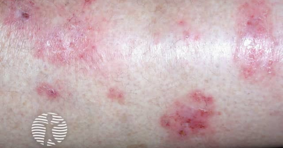 Nummular dermatitis discoid eczema image